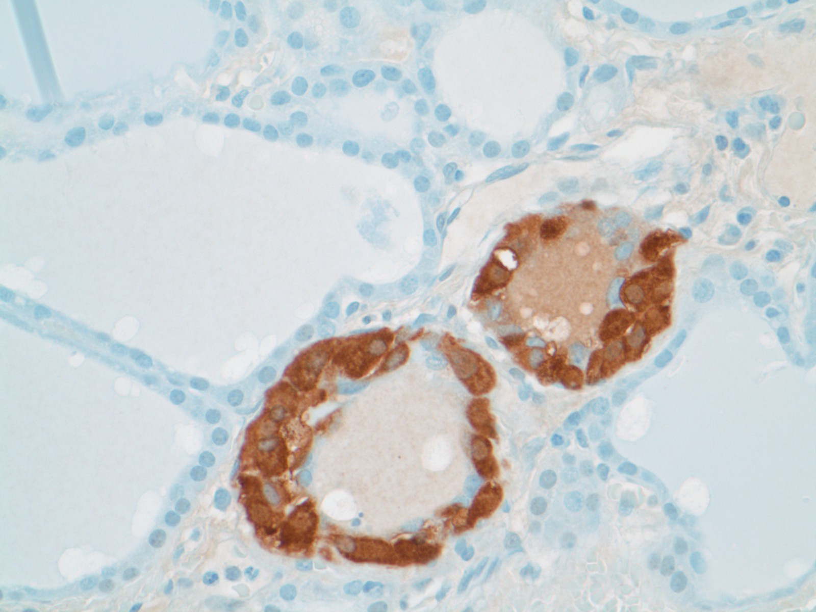Cases: Pathology of Thyroid