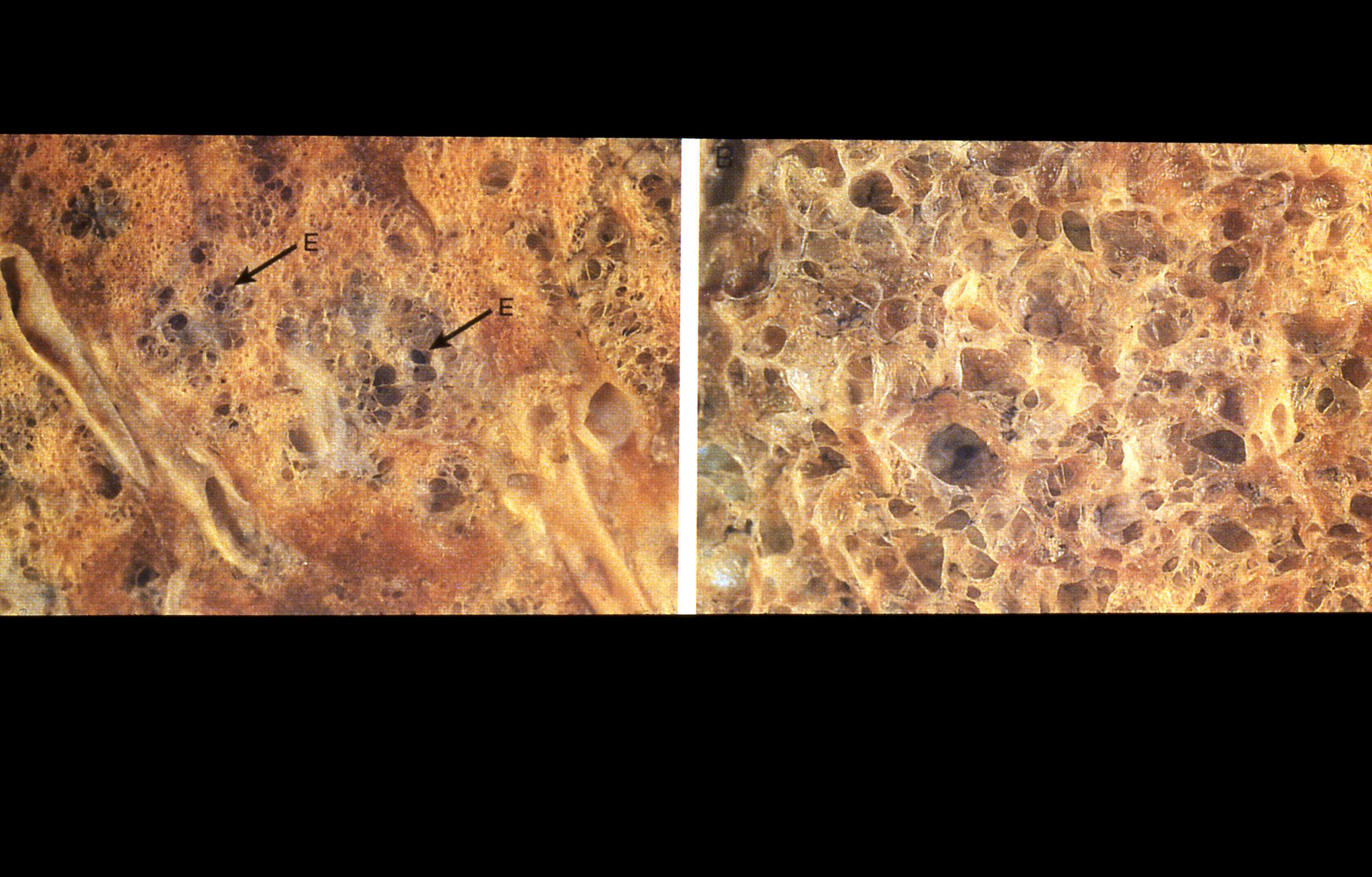 Pathology of Chronic Obstructive Lung Disease