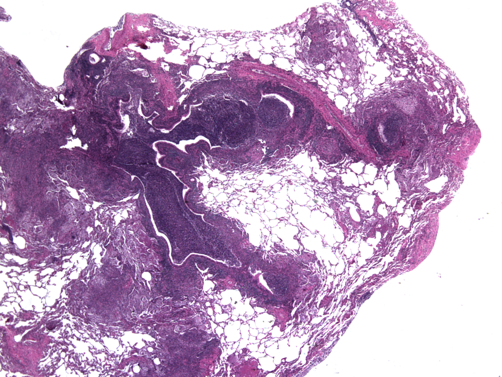 Pathology of Chronic Obstructive Lung Disease