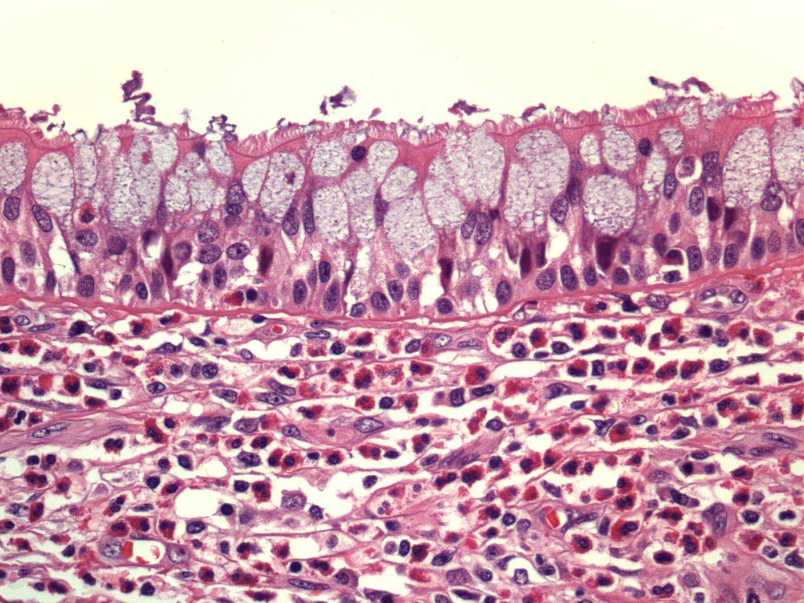 Pathology of Chronic Obstructive Lung Disease
