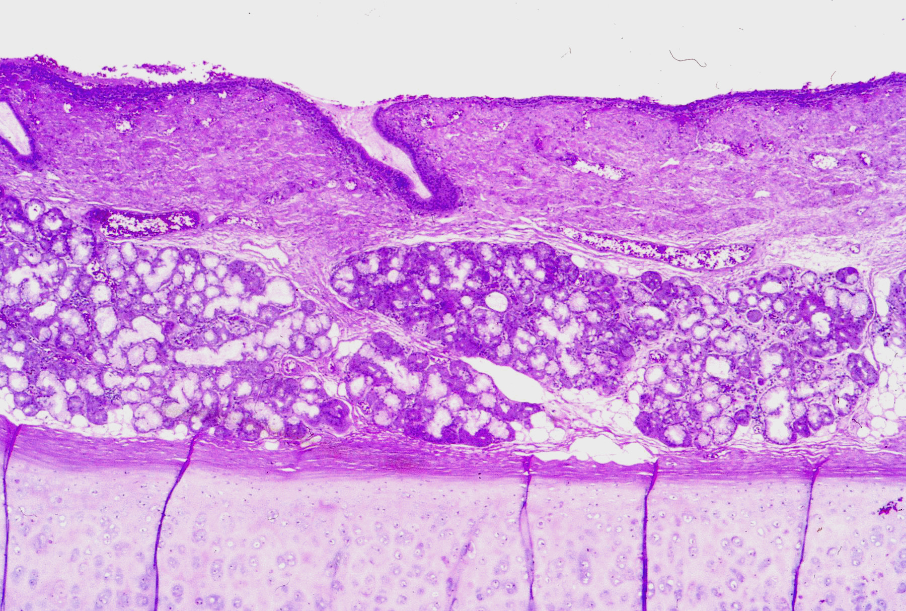 Pathology of Chronic Obstructive Lung Disease